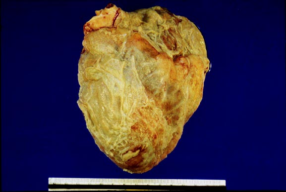 fibrinous pericarditis